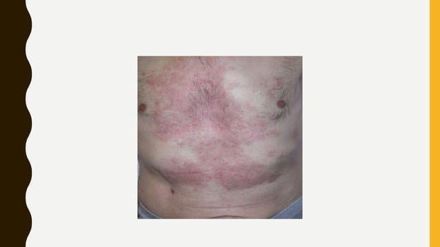 Cutaneous mucinosis | PPTX | Skin and Dermatology | Diseases and Conditions