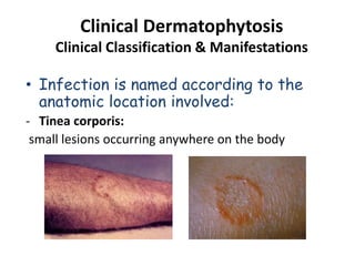 Cutaneous mycoses.ppt