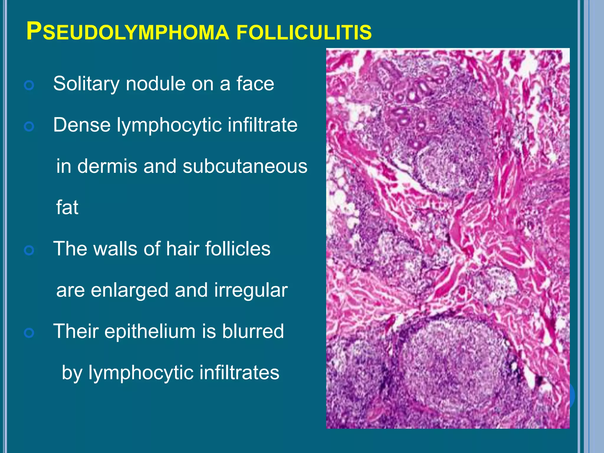 Cutaneous pseudolymphoma | PPTX