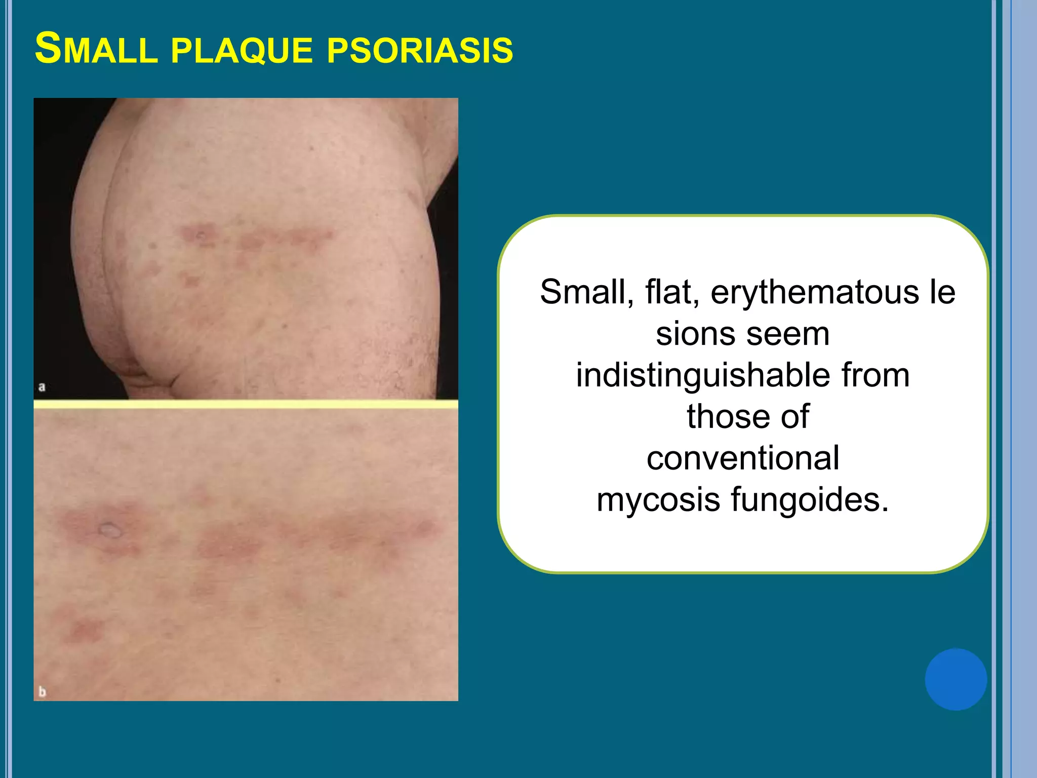 Cutaneous pseudolymphoma | PPTX