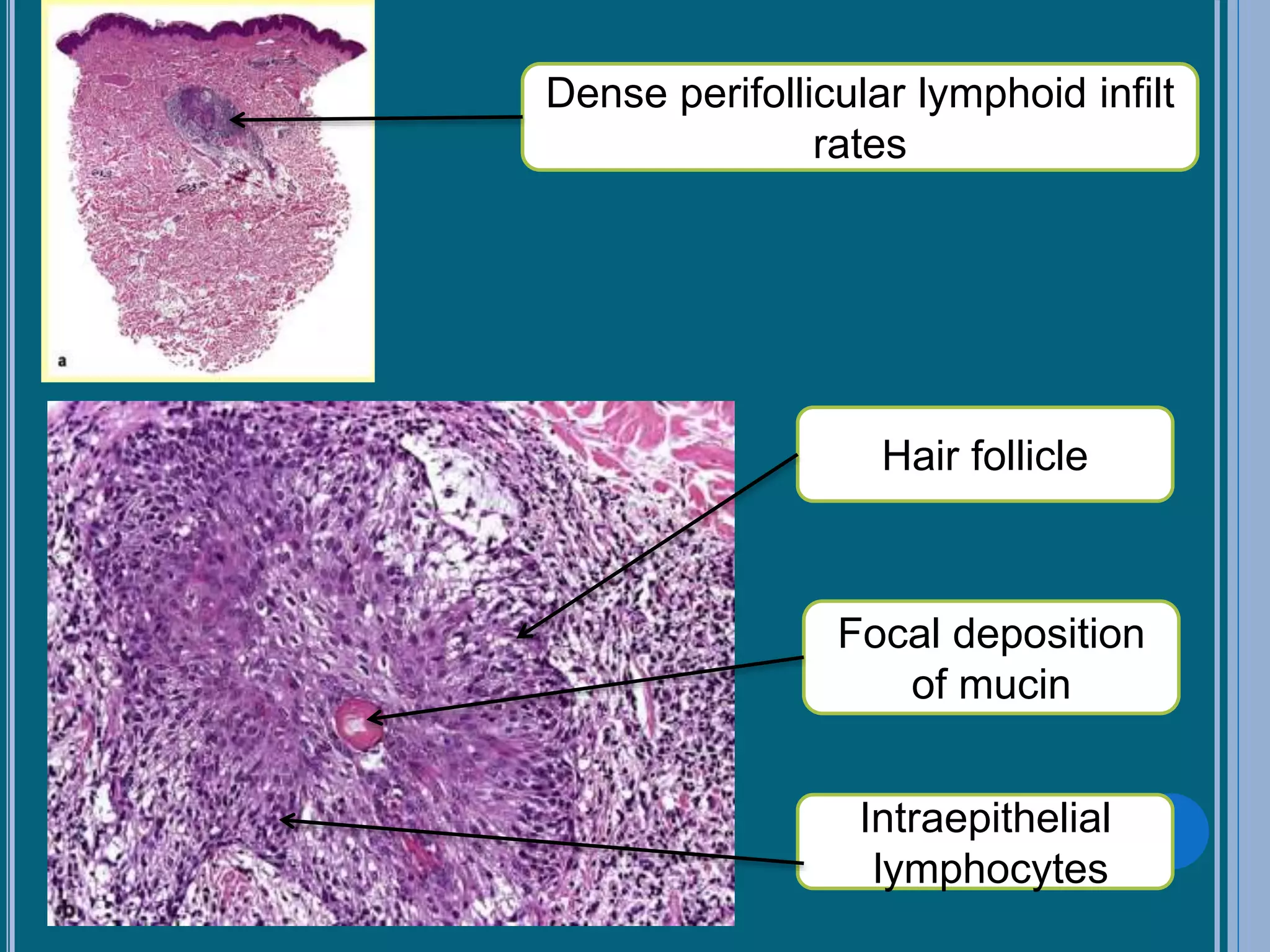 Cutaneous pseudolymphoma | PPTX