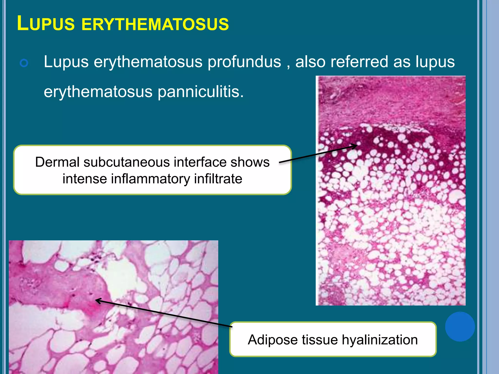 Cutaneous pseudolymphoma | PPTX