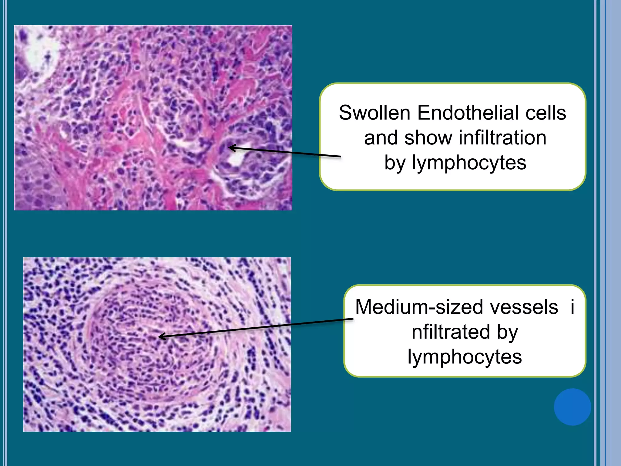 Cutaneous pseudolymphoma | PPTX