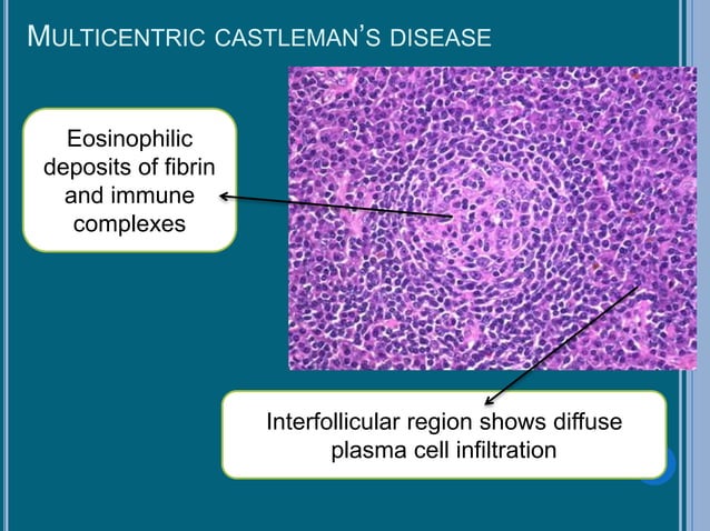 Cutaneous pseudolymphoma | PPTX