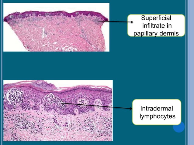 Cutaneous pseudolymphoma | PPTX