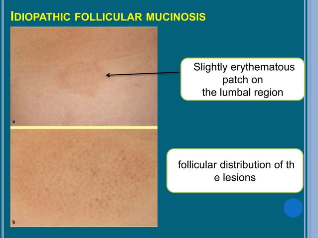 Cutaneous pseudolymphoma | PPTX