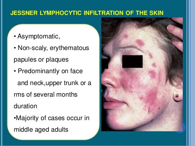 Cutaneous pseudolymphoma