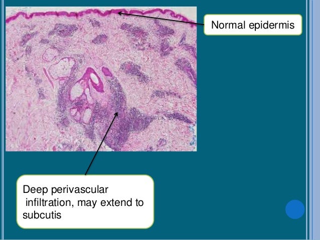 Cutaneous pseudolymphoma