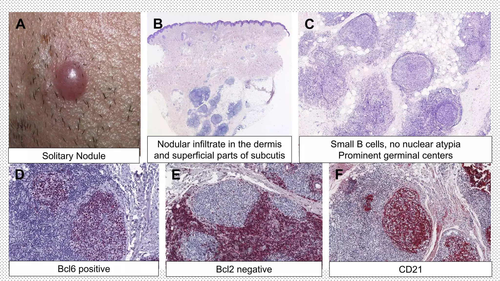 Cutaneous pseudolymphoma | PPTX
