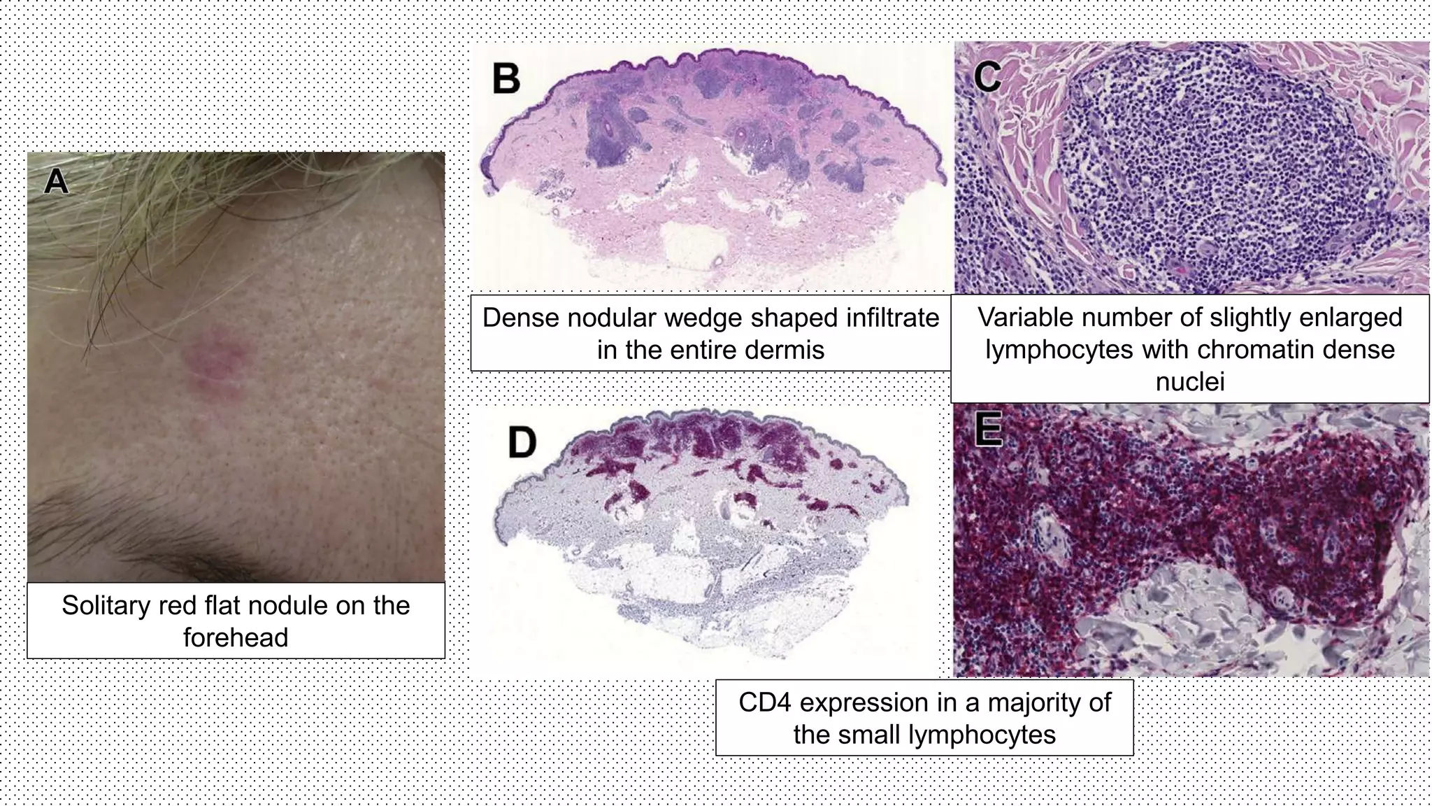 Cutaneous pseudolymphoma | PPTX