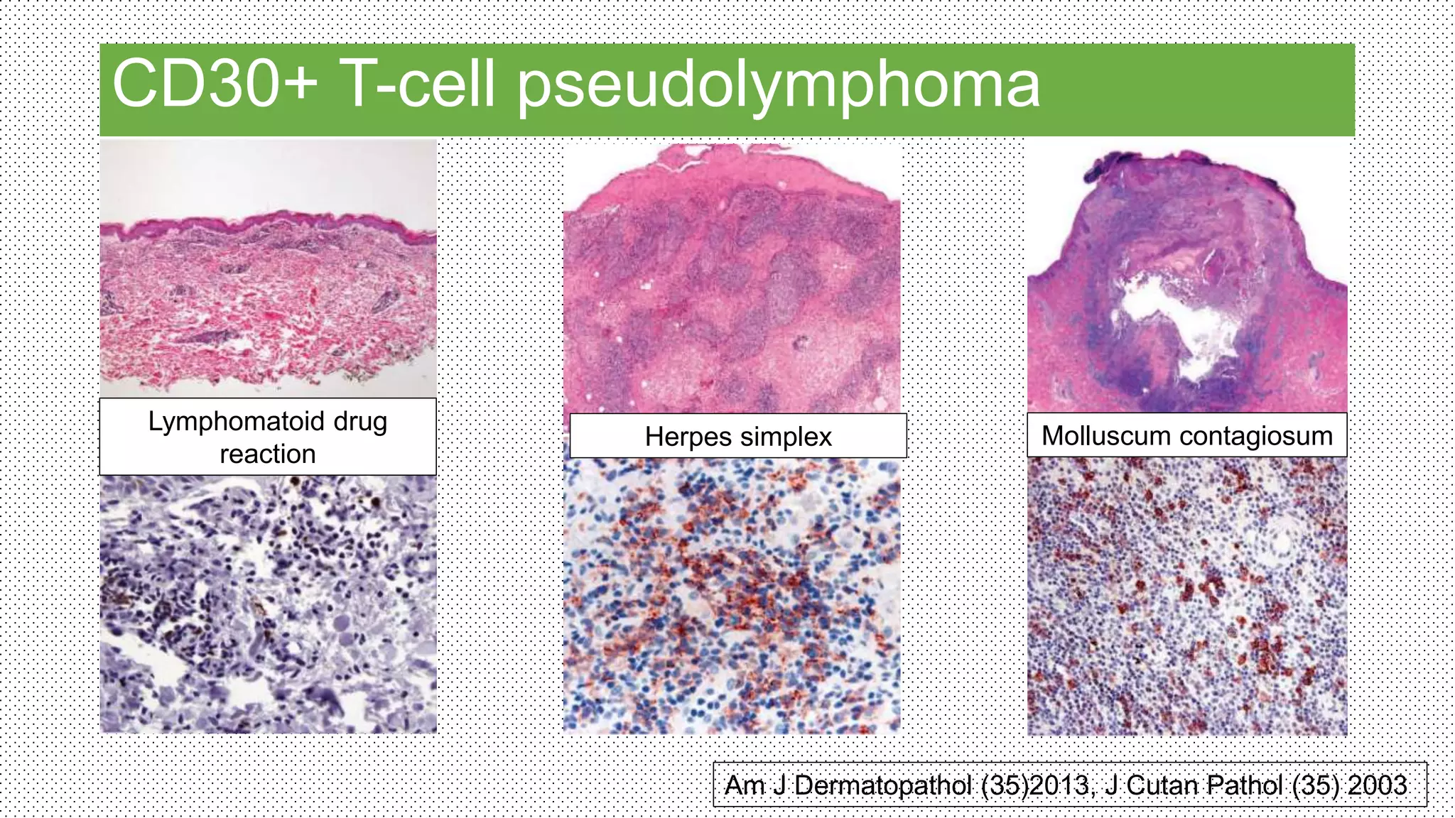 Cutaneous pseudolymphoma | PPTX