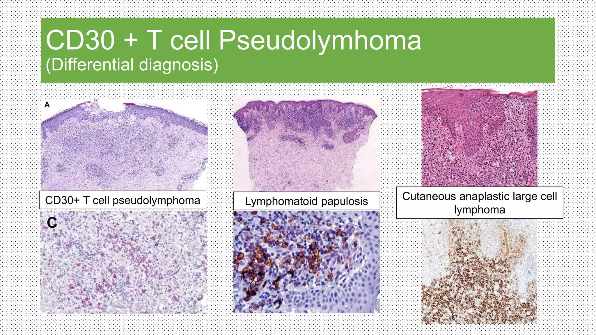 Cutaneous pseudolymphoma | PPTX