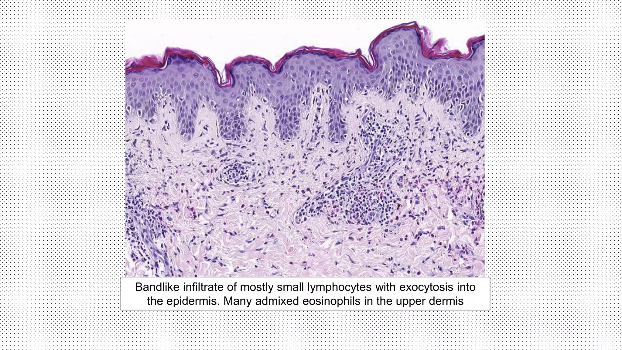 Cutaneous pseudolymphoma | PPTX
