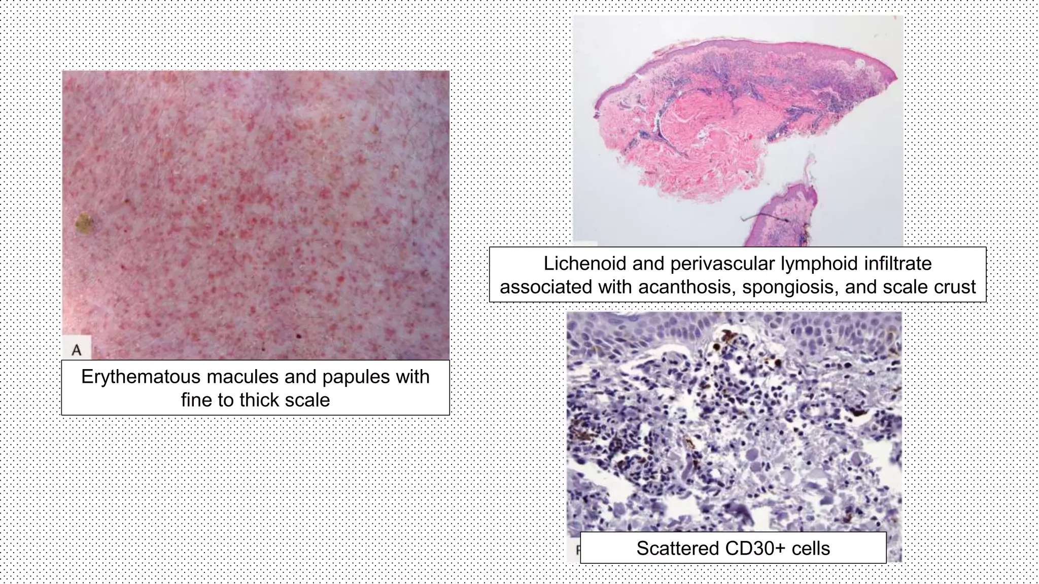 Cutaneous pseudolymphoma | PPTX
