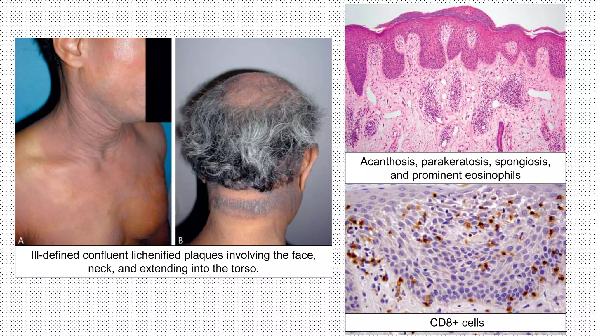 Cutaneous pseudolymphoma | PPTX