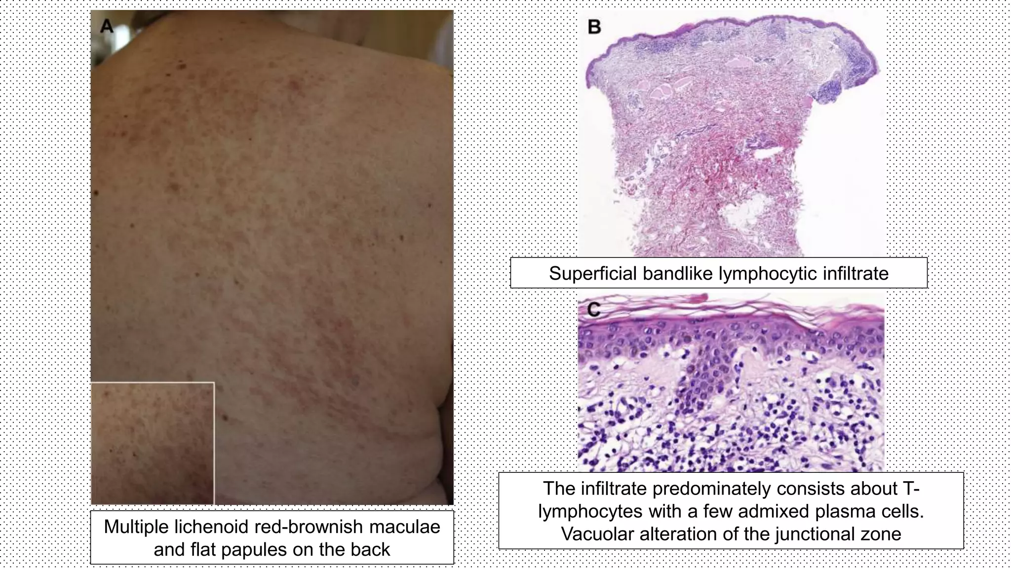 Cutaneous pseudolymphoma | PPTX