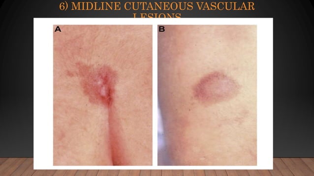 Cutaneous stigmata of spine dr jason | PPT
