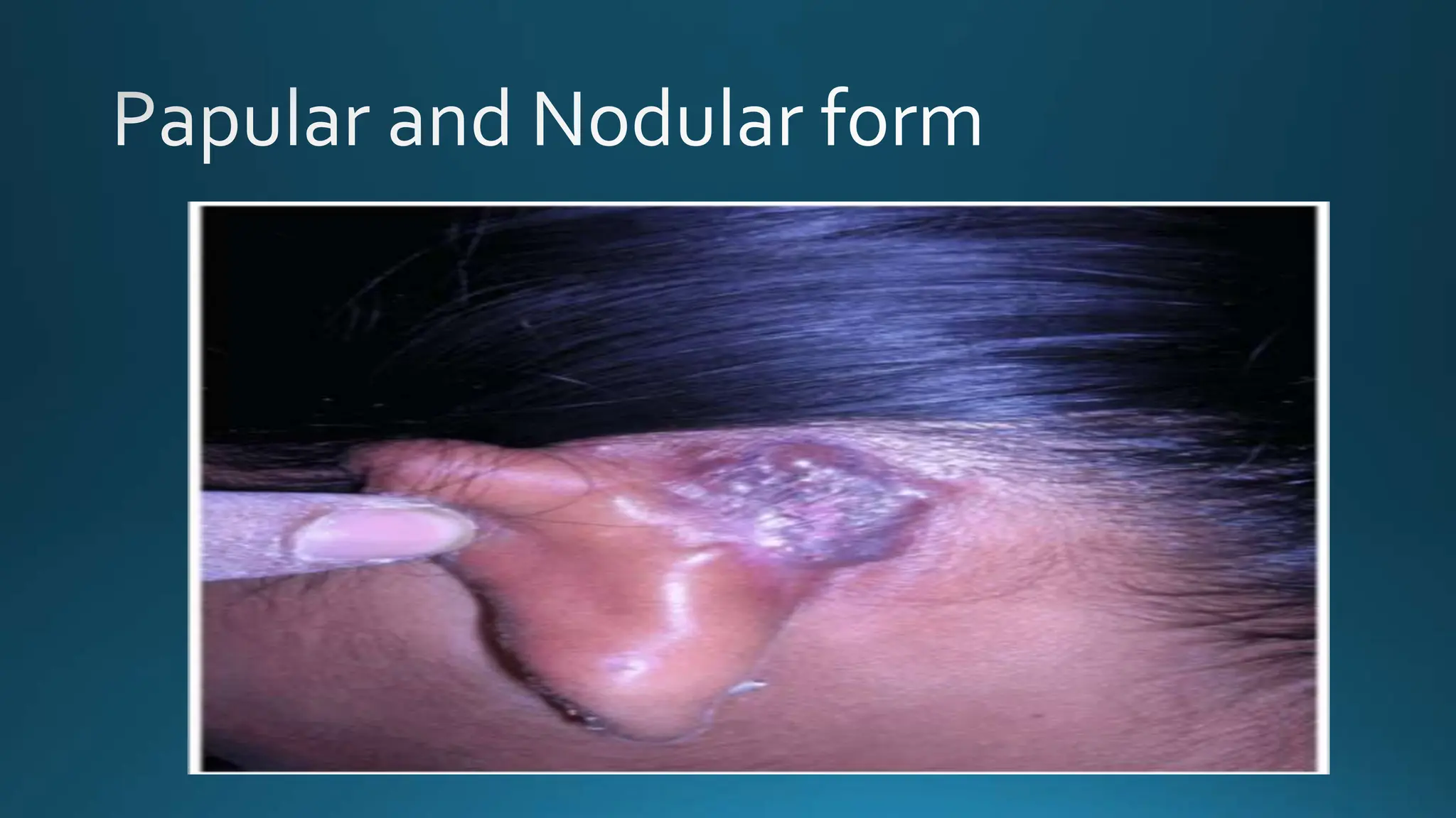 Mamagement and Diagnosis of cutaneous TB.pptx