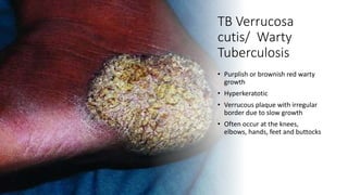 Cutaneous tb dorcas | PPTX