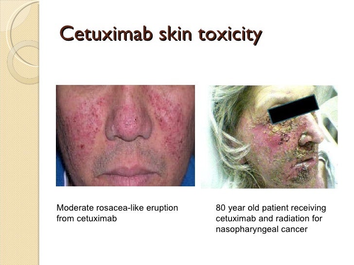 Cutaneous Toxicities Of Cancer Therapy