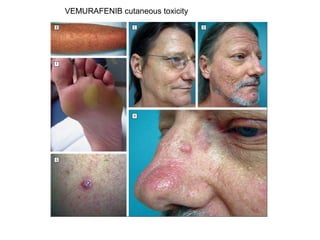 Ipilimumab and BRAF inhibitors cutaneous toxicity | PPT