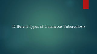 Cutaneous tuberculosis | PPT