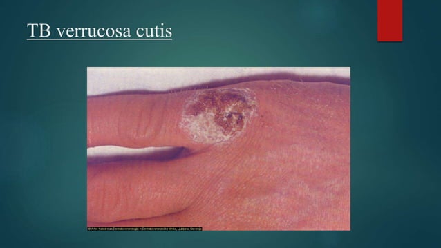 Cutaneous tuberculosis | PPT