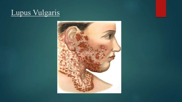 Cutaneous tuberculosis | PPT