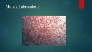 Cutaneous tuberculosis | PPT