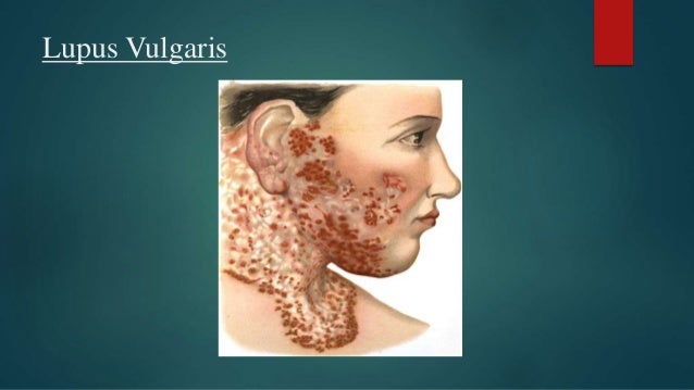 Cutaneous tuberculosis