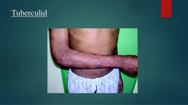 Cutaneous tuberculosis