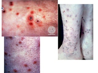 Cutaneous tuberculosis ( SKIN TB ) | PPTX