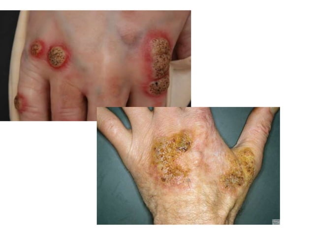 Cutaneous tuberculosis ( SKIN TB ) | PPTX