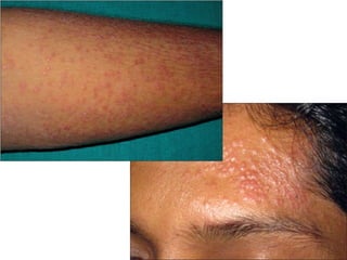 Tubercle Skin Lesion