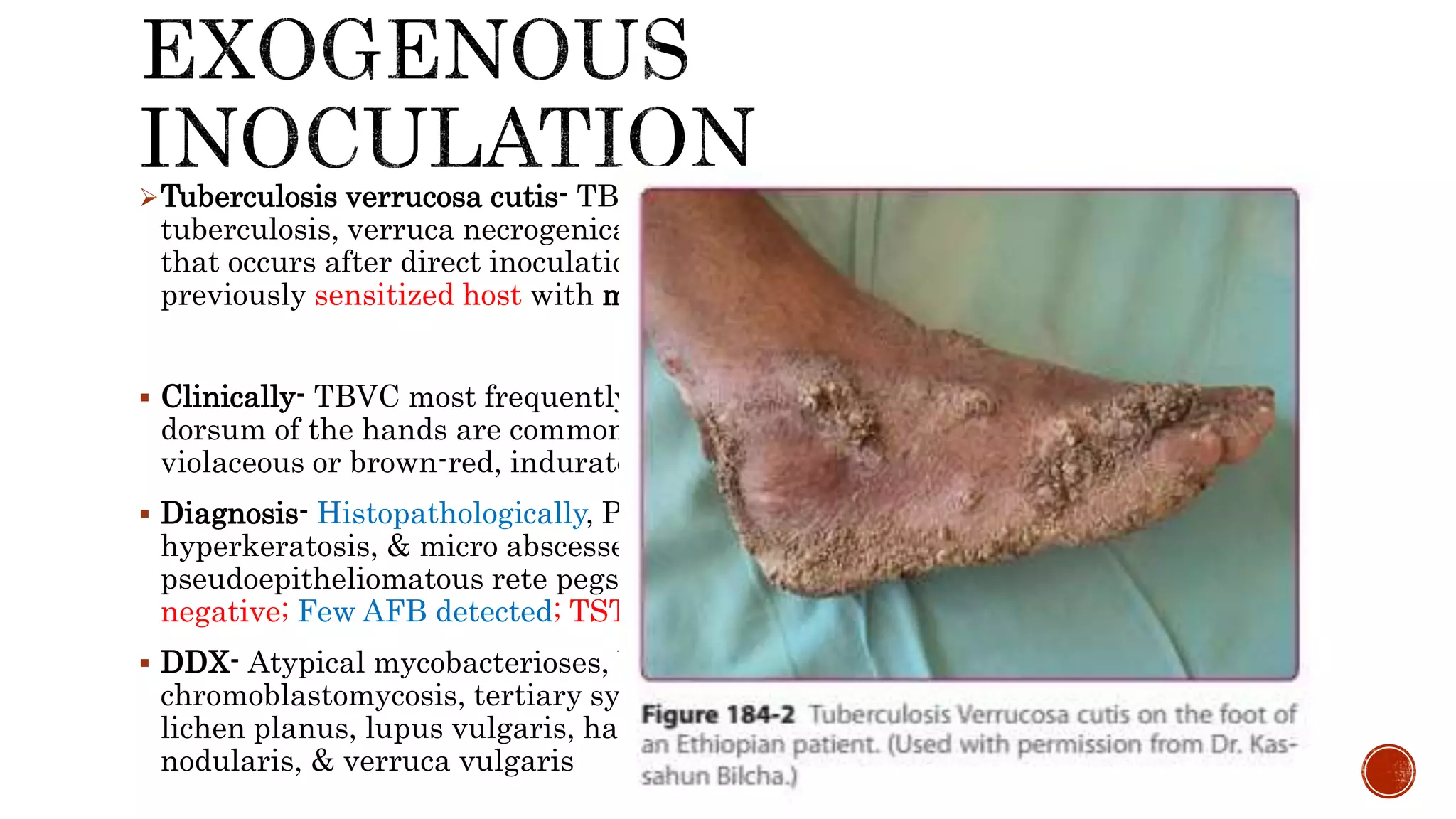 Cutaneous tuberculosis | PPTX