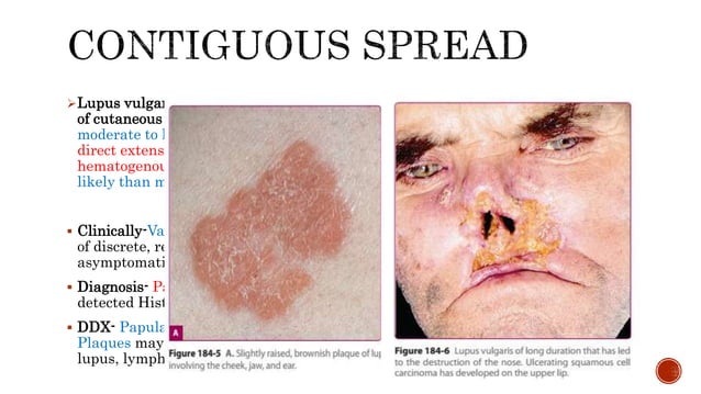 Cutaneous tuberculosis | PPTX | Skin and Dermatology | Diseases and ...