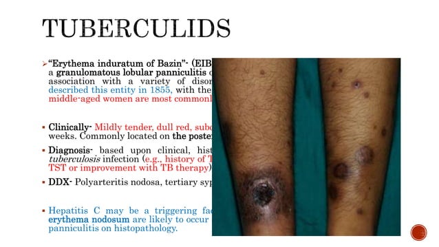Cutaneous tuberculosis | PPTX | Skin and Dermatology | Diseases and ...