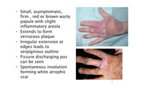 Cutaneous tuberculosis | PPTX