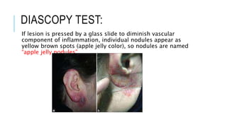 Cutaneous tuberculosis | PPTX