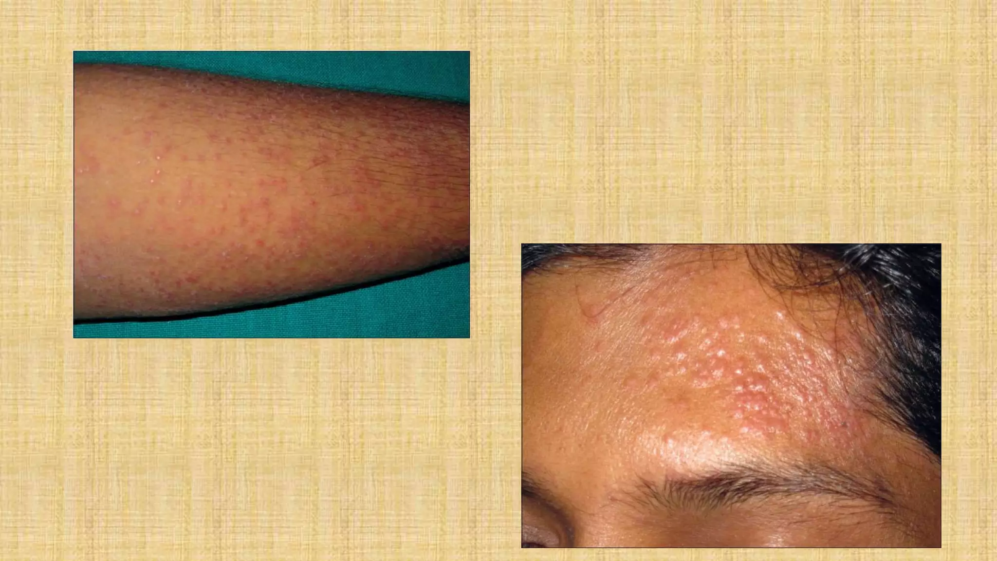 Cutaneous tuberculosis | PPTX