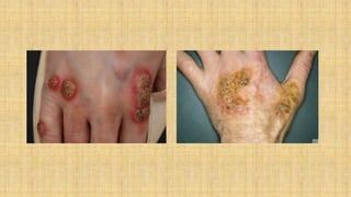 Tubercle Skin Lesions