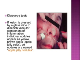 Cutaneous tuberculosis final ppt | PPTX