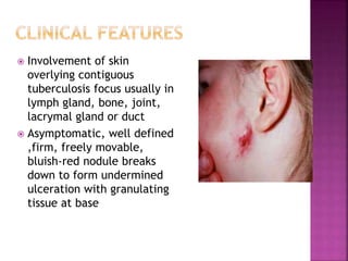 Tuberculosis Skin Symptoms