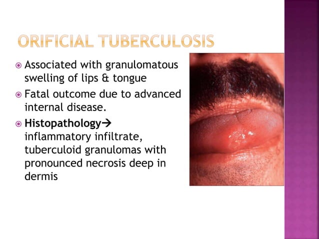 Cutaneous tuberculosis final ppt | PPT