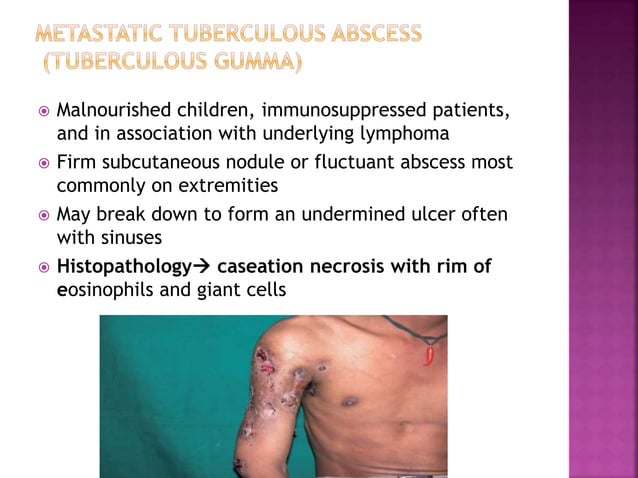 Cutaneous tuberculosis final ppt | PPT