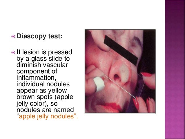 Cutaneous tuberculosis final ppt