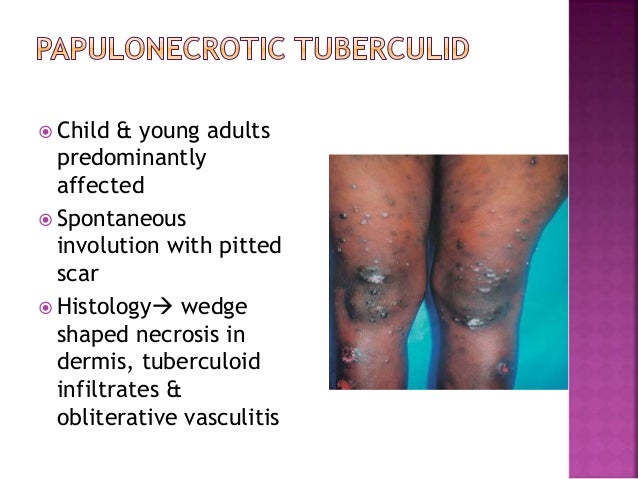 Cutaneous Tuberculosis Final Ppt