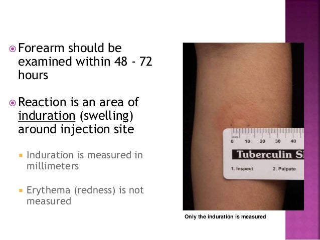 Cutaneous tuberculosis final ppt
