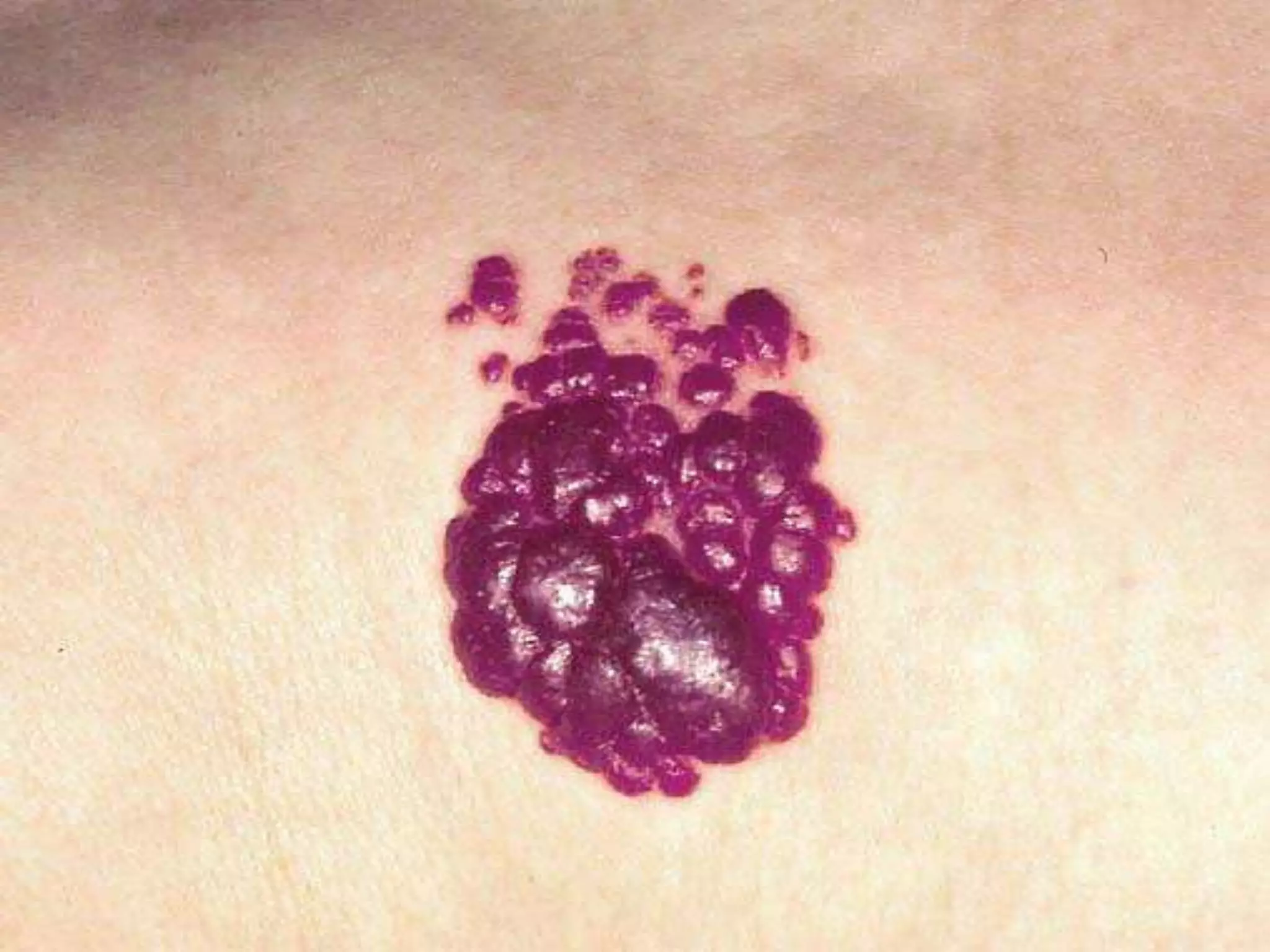 Cutaneous vascular lesions.pptx