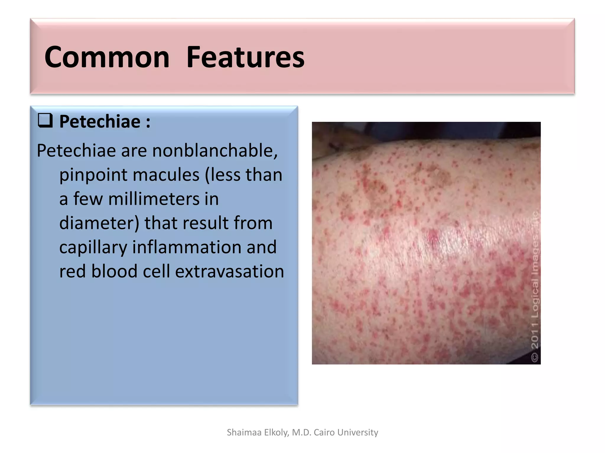 Cutaneous vasculitis | PPTX